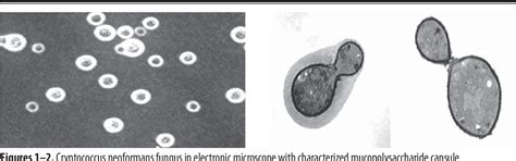 Figure 1 2 From Cryptococcal Neuroinfection In An Adult Patient With Chronic B Lymphatic