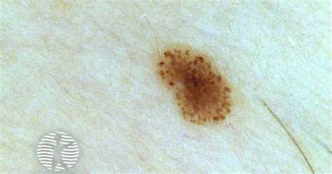 Melanocytic Naevus Image