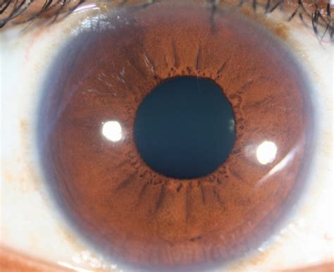 Modern And Multidimensional Iridology Space Risk Multiple Pupil