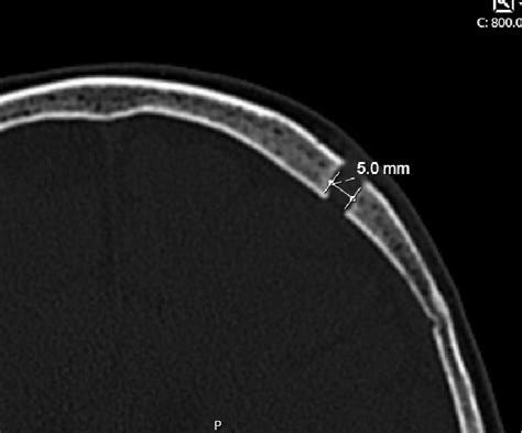 A Segmental Bone Window Reconstruction Of Native Axial Head CT Showing