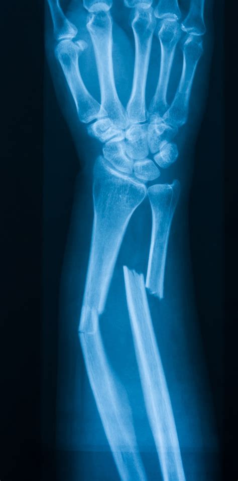 Fractures Injuries Fractures Injuries