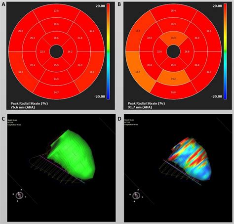 Strain Analysis Using Feature Tracking In A Patient Undergoing Download Scientific Diagram