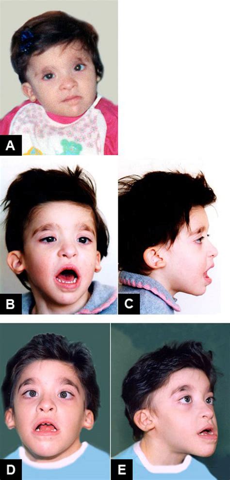 Wilsons Disease
