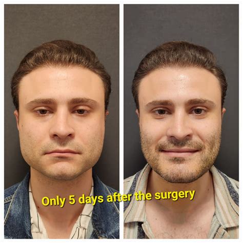 Know About Double Jaw Surgery Before And After