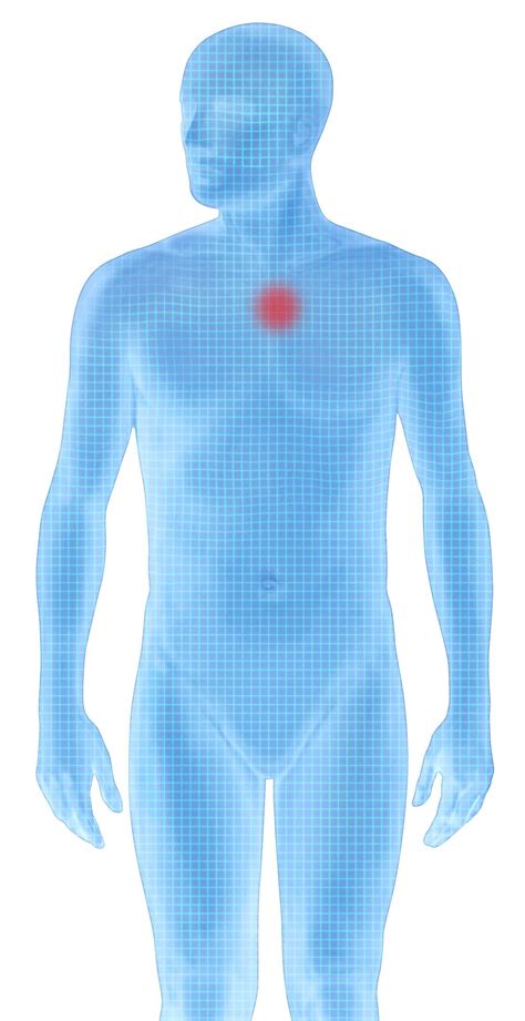 Hiatal Hernia Virginia Heartburn And Hernia Institute