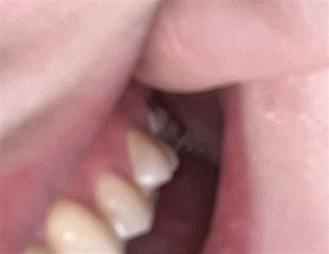 Rotten Tooth Drug Addiction Raskdentists