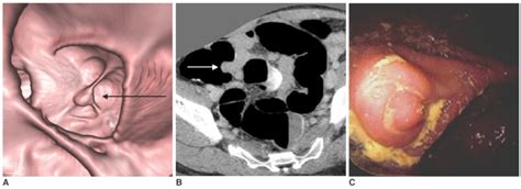A Pseudopolyp At The Appendiceal Orifice In 35 Year Old Asymptomatic
