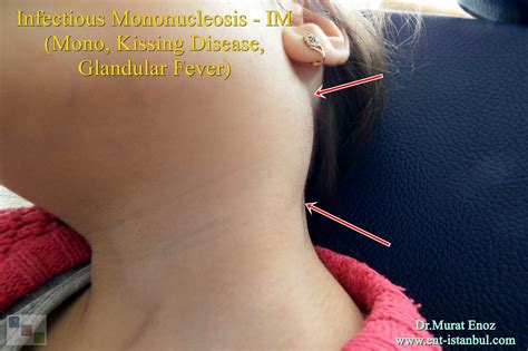 Infectious Mononucleosis Mono Kissing Disease Glandular Fever