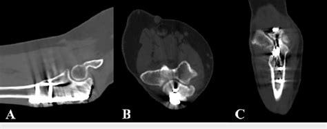 Computed Tomography Scan Of The Left Elbow Sagittal A Axial B