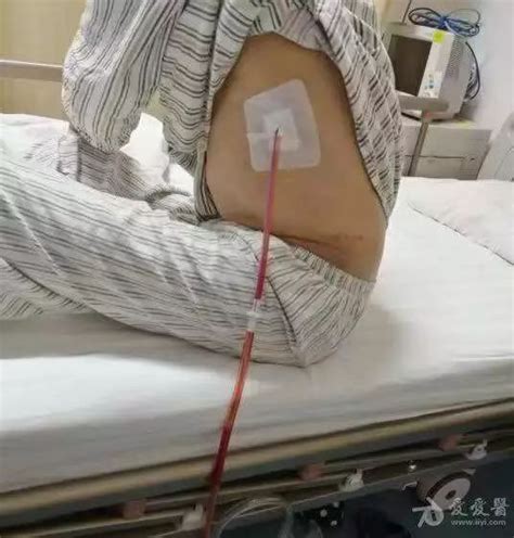 躁动病人胸腔闭式引流管固定 凤凰网健康 凤凰网