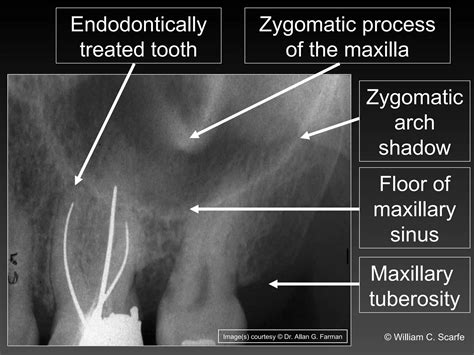 Dental Maxillary And Mandibular Anatomic Radiographic Landmarksppt