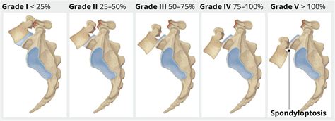 Espondilolisis Y Espondilolistesis Synergia