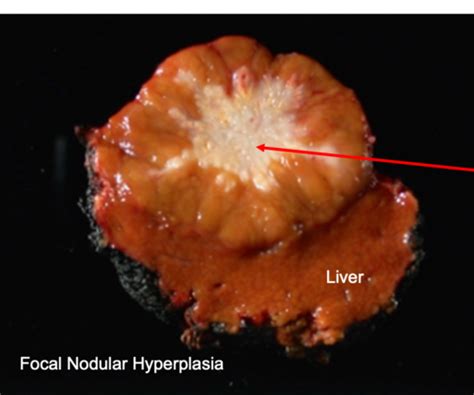Liver Nodules And Tumors Bronza Flashcards Quizlet
