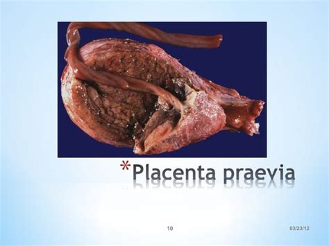 Lower Uterine Segment Ppt