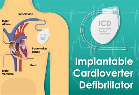 Implantable Cardioverter Defibrillator ICD Placement Cardiovascular