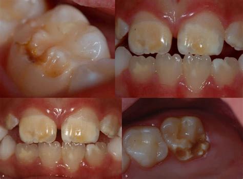 Hipoplasia del esmalte en niños y adultos Clínica Escámez