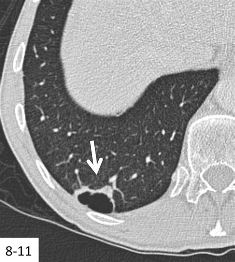 Guidelines For Management Of Incidental Pulmonary Nodules Detected On