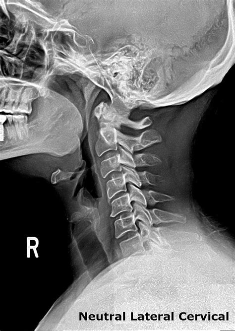 Neutral Lateral Cervical Radiograph Of The Patient Download