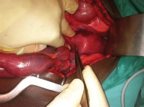 Foreign Body Can Be Seen At Rectosigmoid Junction Download Scientific Diagram