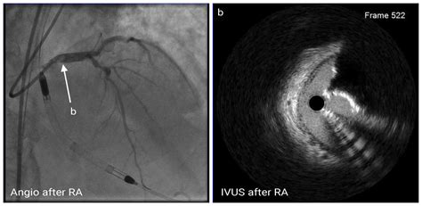 Case 3 Intraluminal Filling Defect In The Proximal LM Cardiology Apps