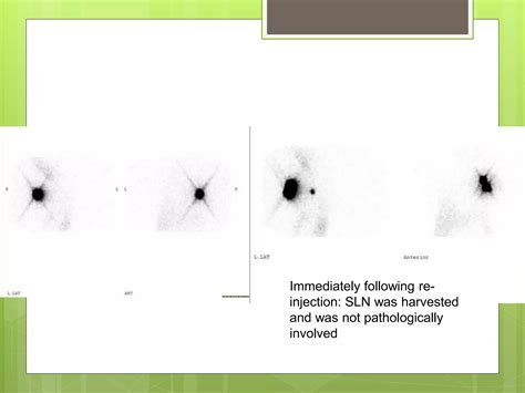 Sentinel Node Mapping In Breast Cancer Controversies Pptx Skin And