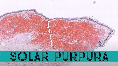 Solar Purpura