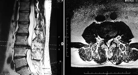 Minimally Invasive Lumbar Spine Surgery — Sohrab Gollogly Md