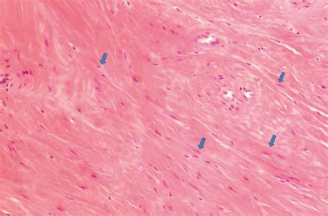 Collagenous Fibroma Arrows Spindled Fibroblasts Microscopic