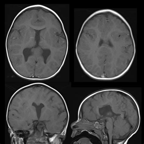Teenager With Developmental Delay Pediatric Radiology Case