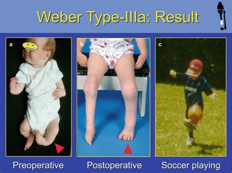 Treatment Of Tibial Hemimelia Plastic Surgery Key