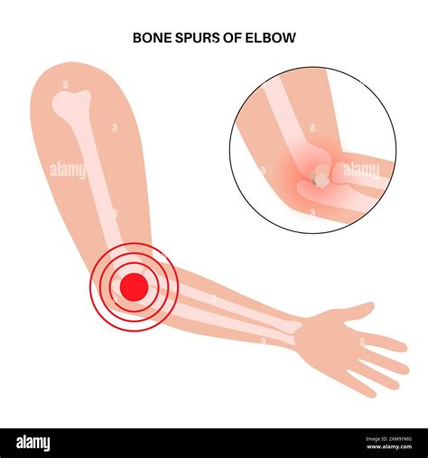 Illustration Of Elbow Arthroscopy Surgery This Is A Procedure For Diagnosing And Treating Joint