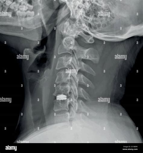 Neck X Ray Of A Patient Undergoing Cervical Microdiscectomy And