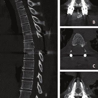 Sagittal A And Axial B D Postoperative Computed Tomography Images