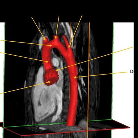 16 cross section of centreline adapted 3d volume mesh from vmtk