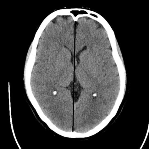 Alignment Of The Sagittal Plane With A Midsagittal Line Between The