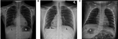 Examples Of Laterality Defects On Radiology Imaging In Various Situs Download Scientific
