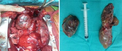 Intraoperative View Dissection Of The Left Lobe And Vascular Download Scientific Diagram