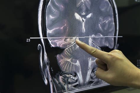 Sarcoidosis Brain Life Expectancy Renda Held