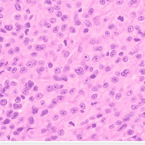 Epithelioid Mesothelioma With Pleomorphic Cells And Mitotic Activity
