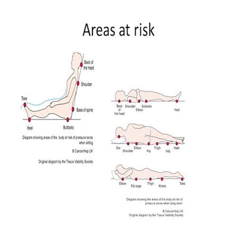 Pressure Ulcer Prevention Half Day Course 9am 1pm Healthcare