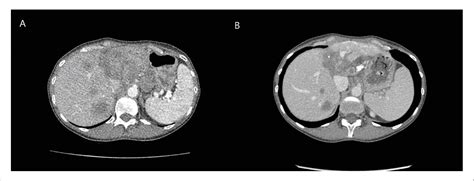 Figure 1 From Clinical Experience With Pemigatinib For Previously