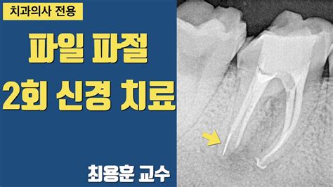 제거 불가능한 근관 기구 파절 그대로 둔 경우 신경치료 치아살리기 최용훈교수 판교최용훈치과 Youtube