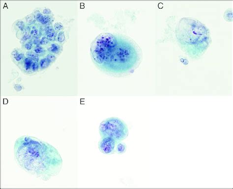 Cytology From Fine Needle Aspiration Of The Pancreatic Head Mass