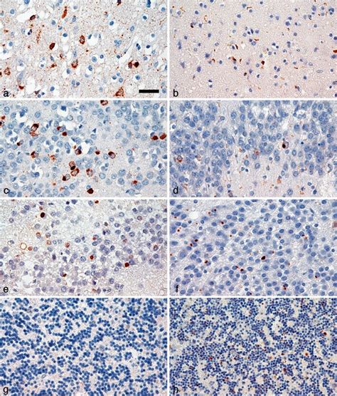 Neuropathology Observed In Sqstm1 Mutation Carriers Immunostaining For