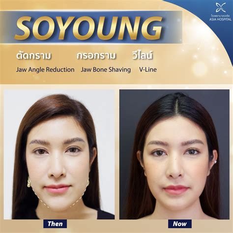 ศัลยกรรมหน้าเรียว เสริมจมูก เอเชียคลีนิก หมอทนงศักดิ์