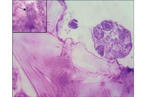 Hydatid Cyst Laminated Membranes With Brood Capsules And Insert Showing