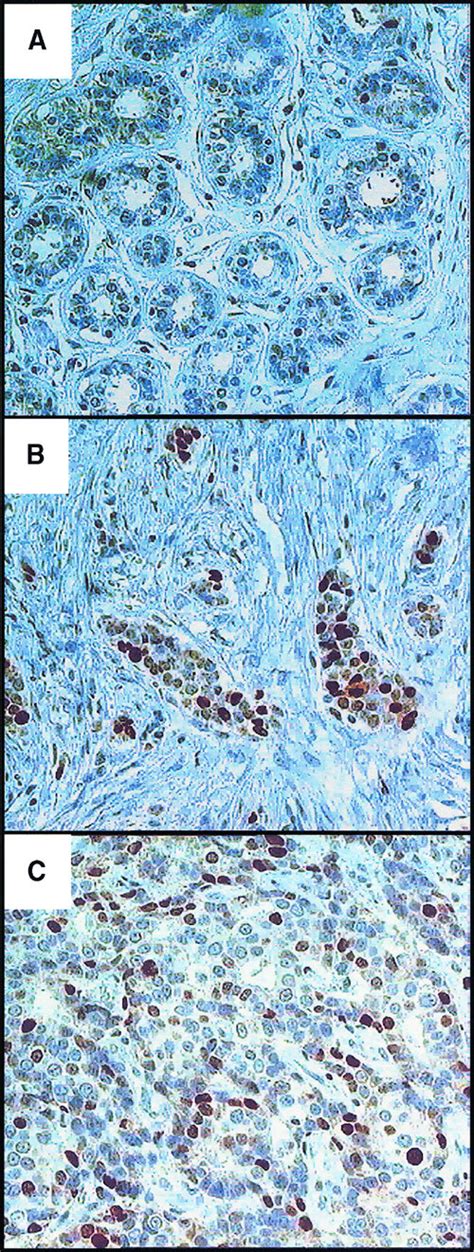 Icbp90 Expression In Normal Breast Tissue And Breast Carcinomas
