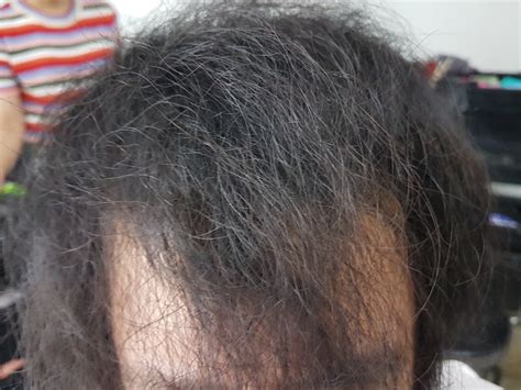 너무 심한 악성 곱슬머리에 이마가 아주 넓은 분의 헤어 고민 네이버 블로그