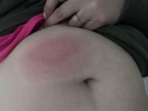 Dupixent Injection Site R Eczemabs