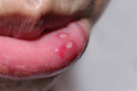 Canker Sore Mouth